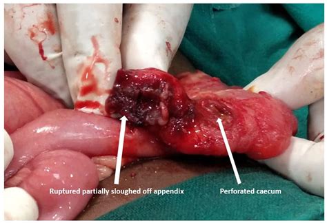 Perforated Appendix