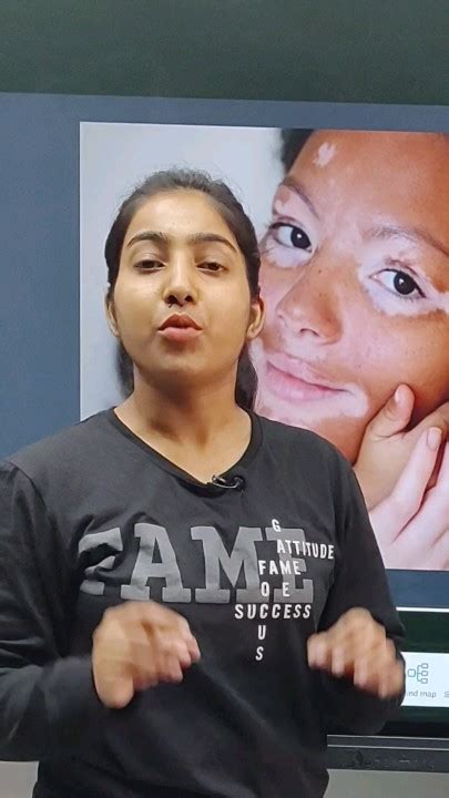 Alka Thakur On Linkedin Alkathakur Linkedinvideo Vitiligo