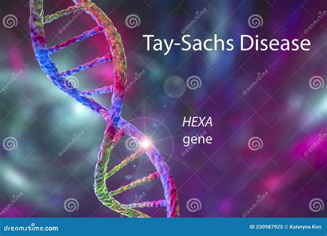 Tay Sachs Disease 3d Illustration Stock Illustration Illustration Of