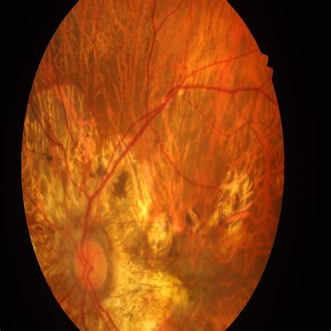Retinal Detachment Dataset Ieee Dataport