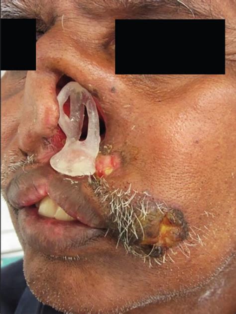 Nasal Prosthesis With Magnetically Secured Intranasal Framework For A Patient With Partial