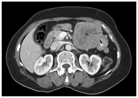 Uncinate Process Ultrasound