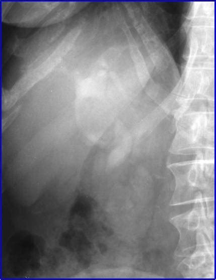 Intraductal Cholangiocarcinoma Ivc Radrounds Radiology Network