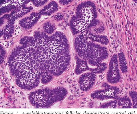 Figure 1 From A Rare Case Of Ameloblastic Carcinoma Semantic Scholar