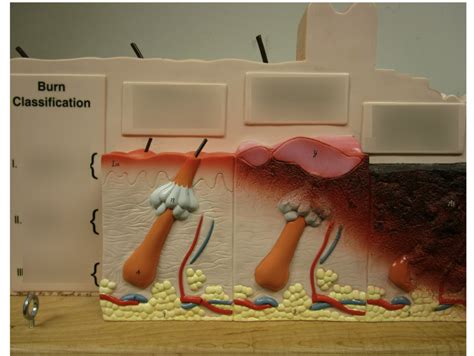 Burn Classification Diagram Quizlet