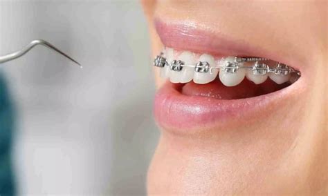 Ai Tool For Braces By 3shape Preeti Cholleti Posted On The Topic