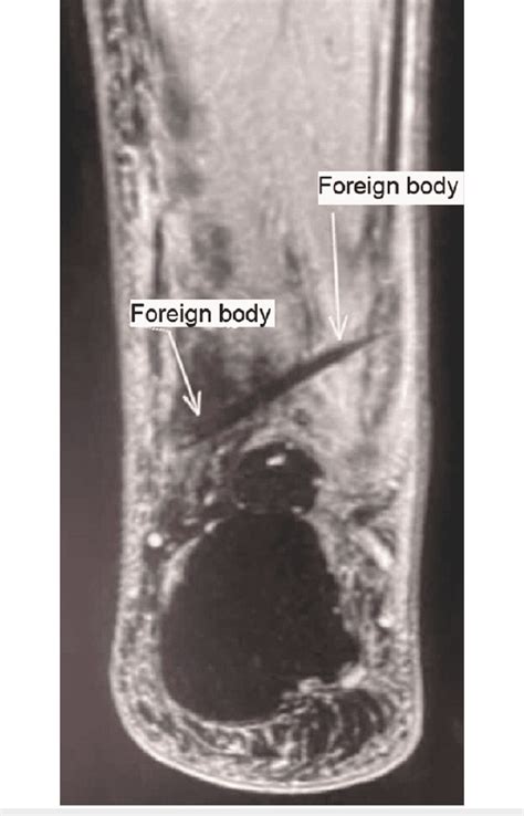 Mri In T2 Sequence Showing A Foreign Body Marked By The Arrows