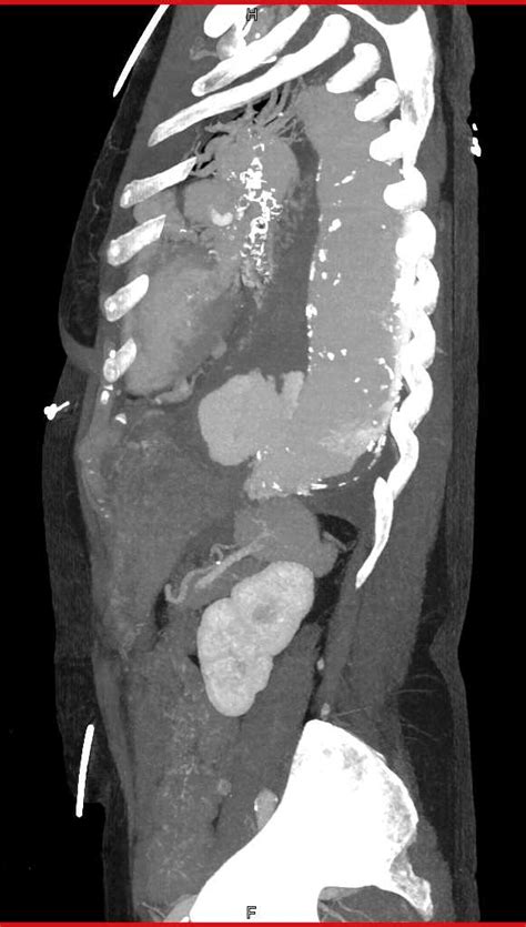 Large Aortic Aneurysm With Turbulent Flow And Ulceration And Bleed