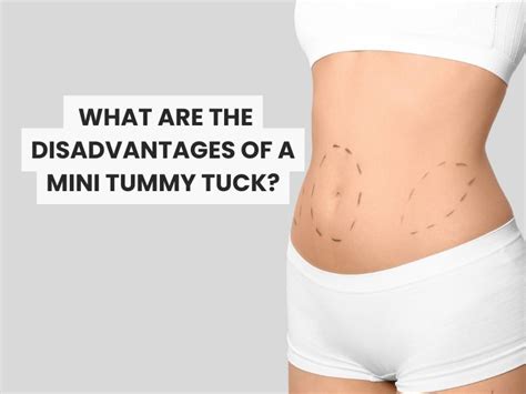 How To Handle Mini Tummy Tuck Regrets Dr Charles Galanis