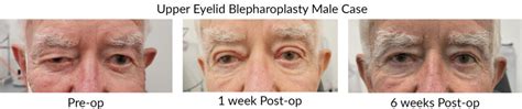 Blepharoplasty Dr Jonathan Kam Ophthalmologist Melbourne