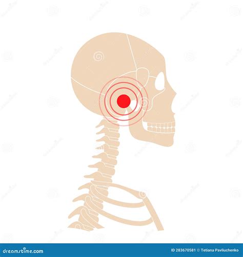Tmd Tmj Disorder Stock Vector Illustration Of Bone 283670581
