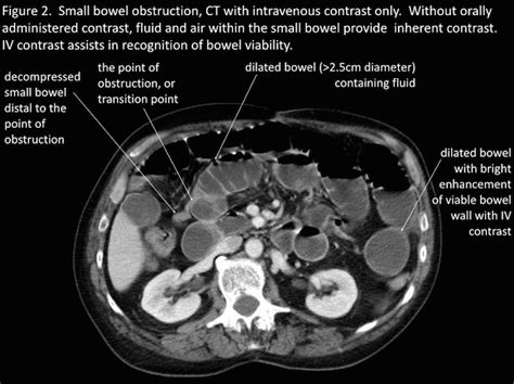 Small Bowel Obstructionwhat To Know