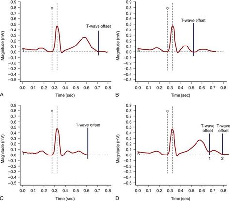 Q T Interval QT Dynamicity And QT Variability Thoracic Key