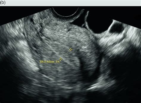 Anteverted Uterus Ultrasound