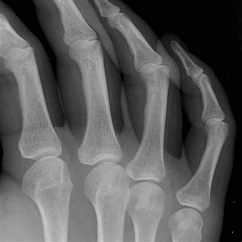 Nutrient Canal Radiograph