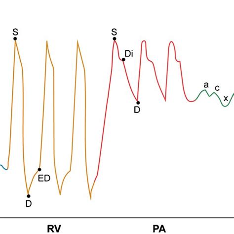 Normal Pulmonary Artery Catheter Pressure Waveform Tracing Ra Blue