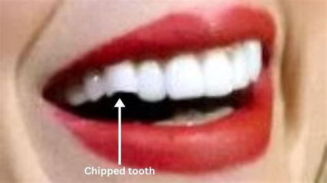 Taylor Swift Teeth Taylor Swift Before And After Teeth