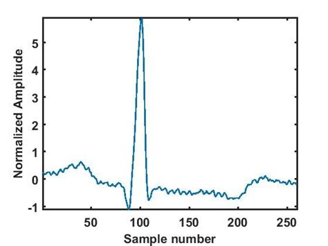 Supraventricular Ectopic Beat Download Scientific Diagram