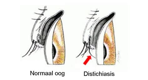 Distichiasis Bij Mensen