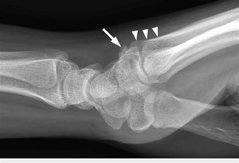 Lateral Radiographic Projection Of The Symptomatic Wrist Demonstrating