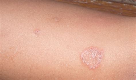 Is It Ringworm Signs And Symptoms