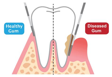 Gum Periodontal Disease Treatment Deep Scaling Philippines