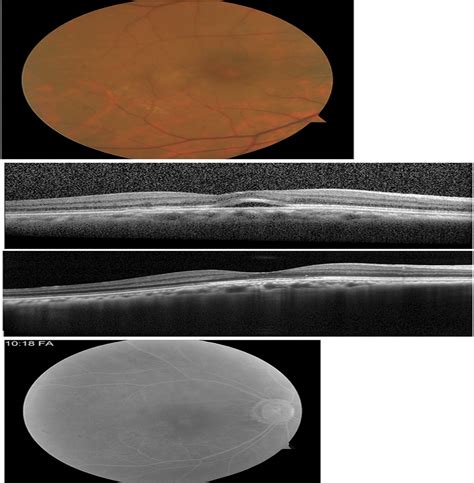 Dome Shaped Maculopathy Enhanced Visualization With Radial