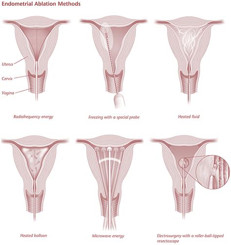 Before And After Endometrial Ablation Endometrial Cryoablation