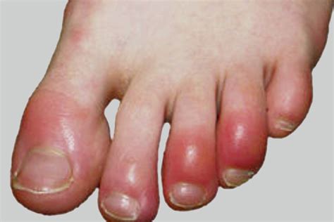 Chilblains Medical Term At Howard Franklin Blog