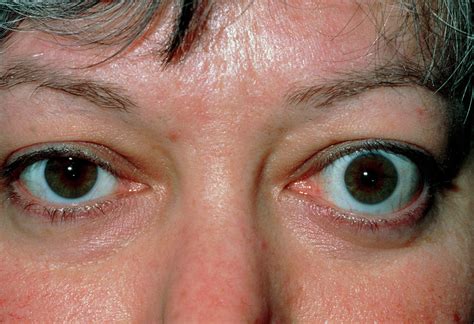 Bulging Eye Exophthalmos Due To Thyrotoxicosis Photograph By Dr P