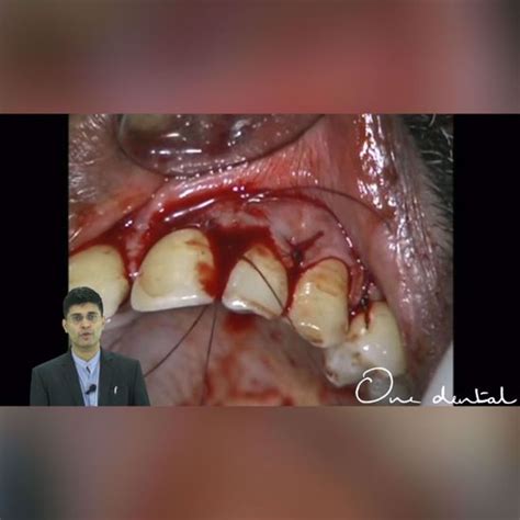 Root Coverage Using Connective Tissue Graft One Dental Is The Biggest Online Platform For Dentistry