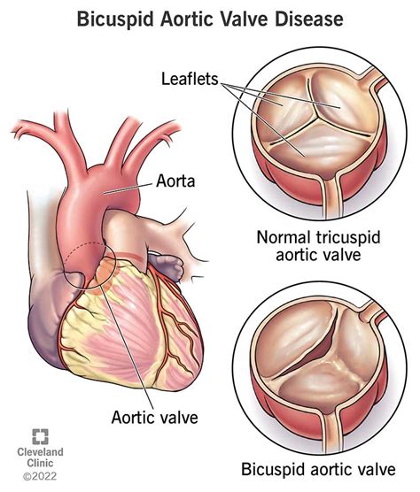 Bicuspid Aortic Valve Types The Hereditary Basis Of Bicuspid Aortic