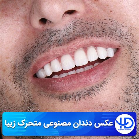 عکس دندان مصنوعی متحرک زیبا نمونه‌کارهای های دنت ️💯