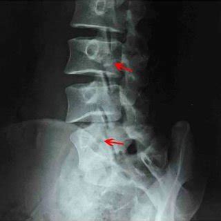 X Ray Ls Spine Oblique View Showing Typical Appearance Of Pars Defect