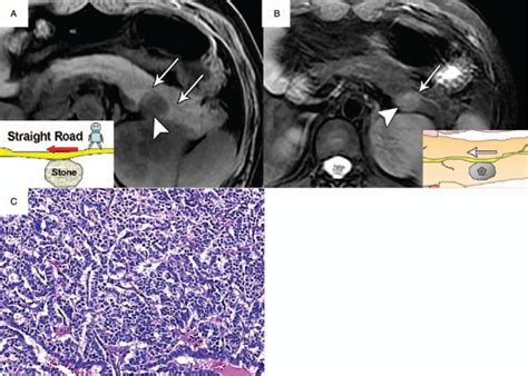 Differentiating Pancreatic Neuroendocrine Tumors From Pancreatic Ductal