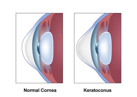 Keratoconus Denver Co Hines Sight