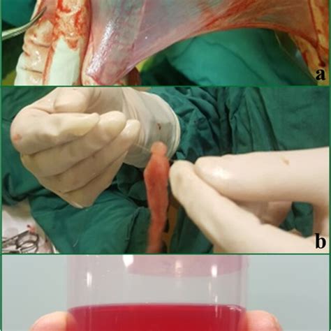 A Isolation Of The Amniotic And Chorionic Layers B Ligation Of The