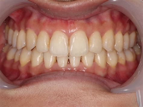 Case Gallery Clearcorrect