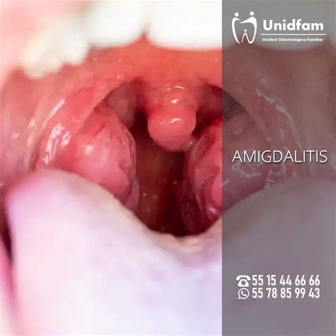 Unidfam La Inflamación De Las Amígdalas Es Causada Principalmente Por