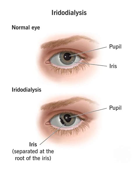 Iridodonesis Symptoms Causes And Treatment