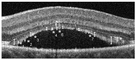Evaluation Of Relationship Between Photoreceptor Outer Segment Layer