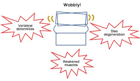 Ilcs Treatment For Lumbar Instability International Lumbago Clinic