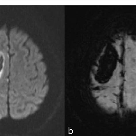 A Diffusion Weighted And B Susceptibility Weighted Mri Sequences Download Scientific Diagram
