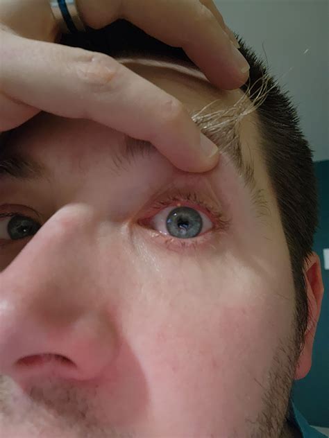Eyelid Pimple Inside
