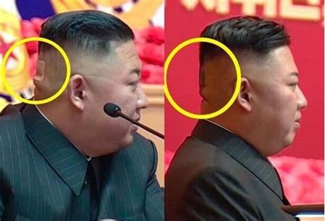 انتشار تصویری از کیم جونگ اون با بانداژی بر پشت سر ایسنا