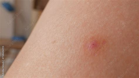 Mosquito Bites Ticks On Womans Legs Big Red Spots On Skin Lyme