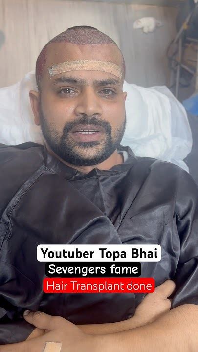 Youtuber Nadeem Banni Hair Transplant Hair Sevengers Sevengersofficial Youtuber Ytshorts