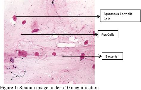 Detection And Summation Of Squamous Epithelial Cells In Sputum Slide My Xxx Hot Girl