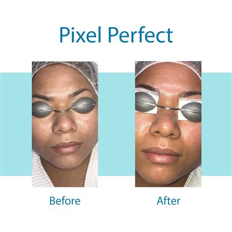 Pixel Laser After Treatment