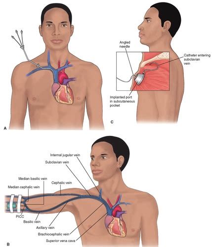 Triple Lumen Catheter Placement